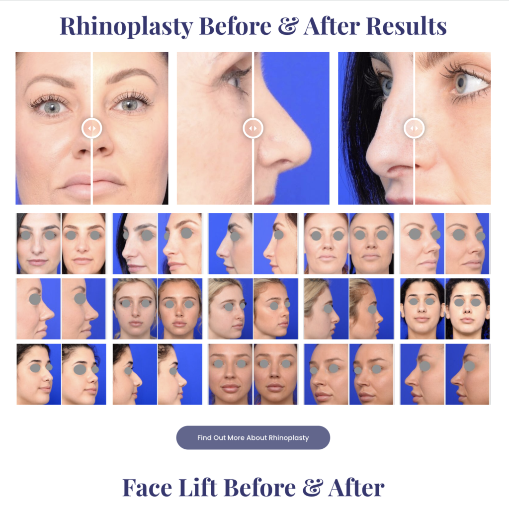 Plastic Surgery Before and After - Dr Rodrigo Teixeira